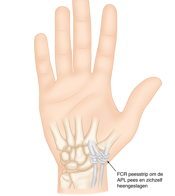 Over de behandeling van CMC1 artrose - Wynand Melenhorst